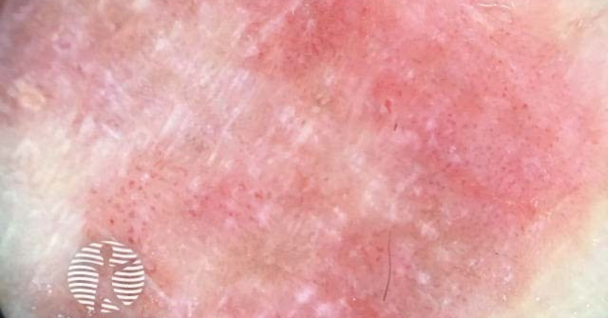 Intraepidermal carcinoma dermoscopy image