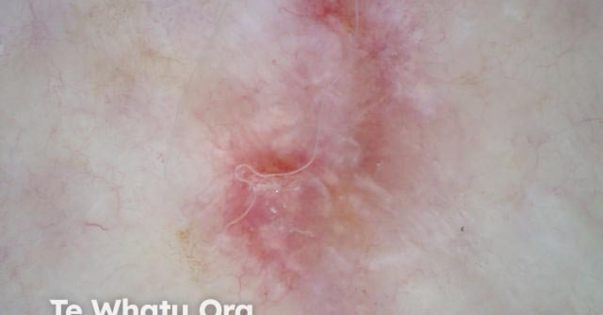 Intraepidermal carcinoma dermoscopy image