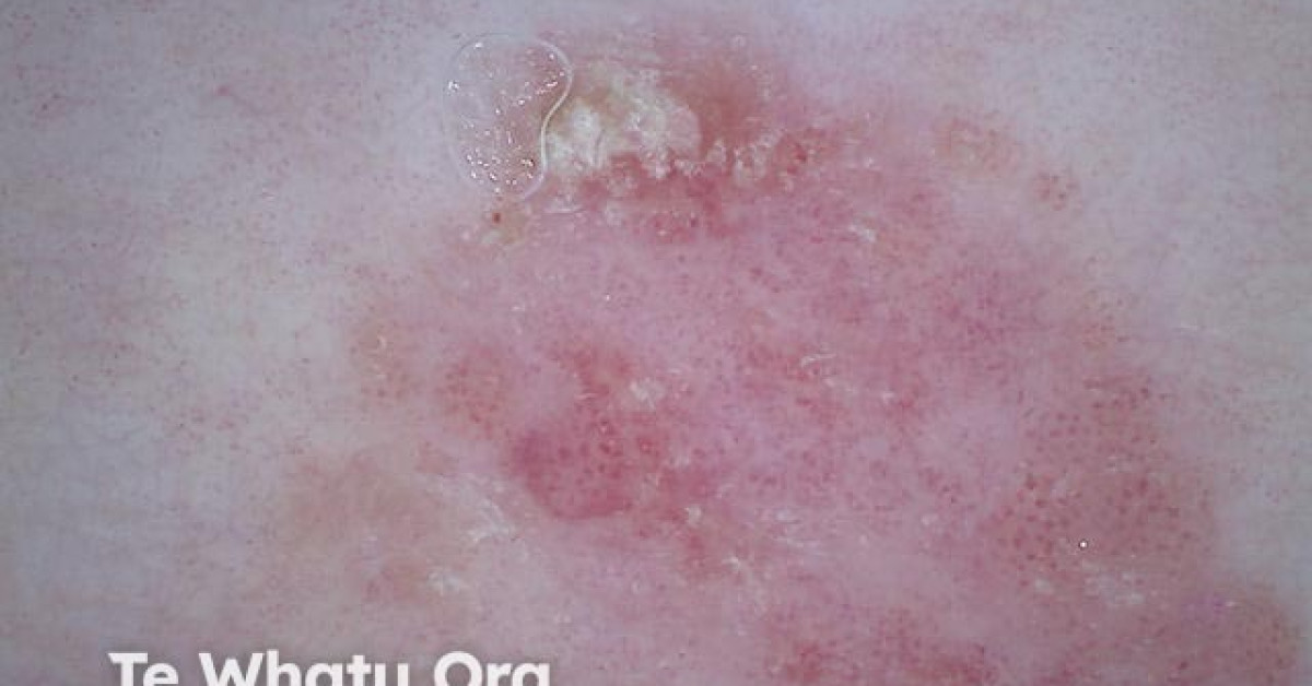 Intraepidermal carcinoma dermoscopy image