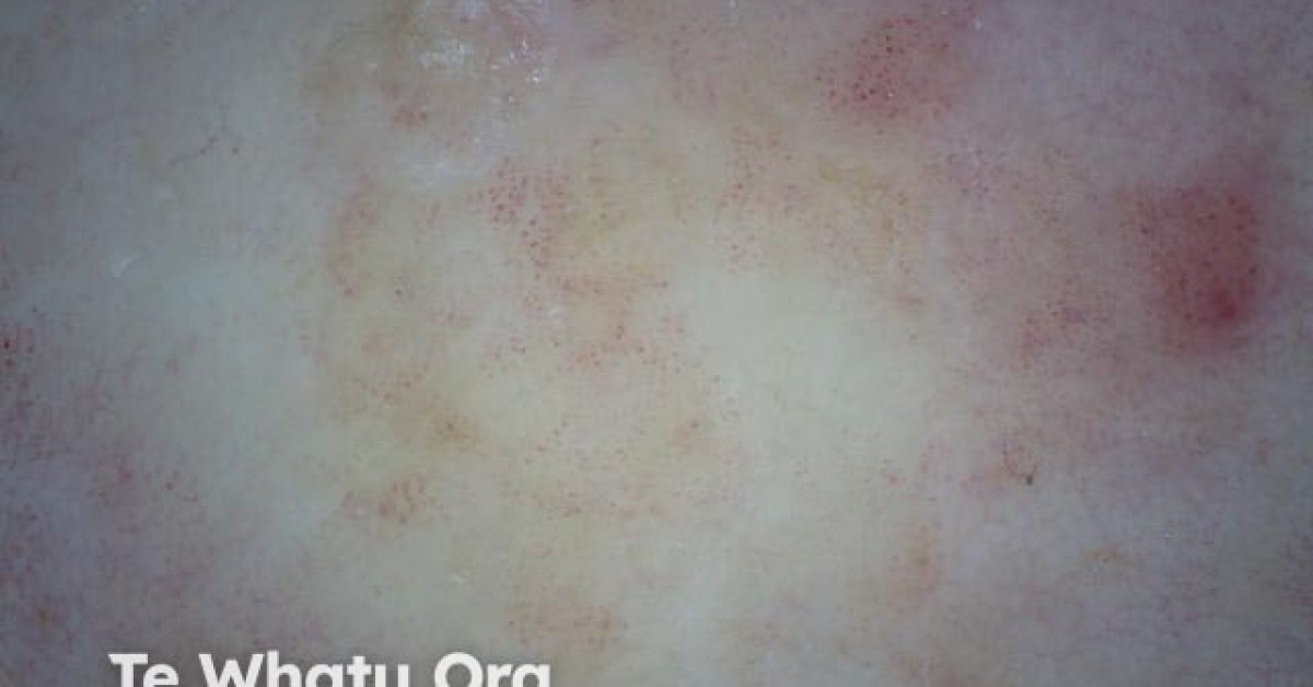 Intraepidermal carcinoma dermoscopy image