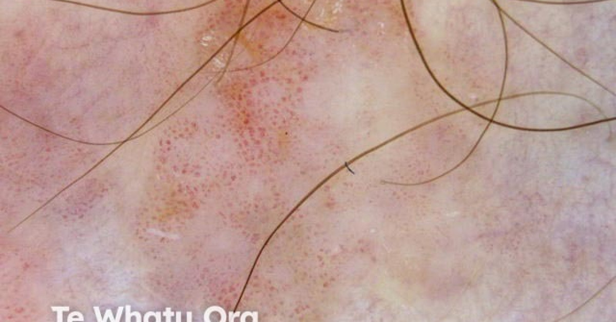 Intraepidermal carcinoma dermoscopy image