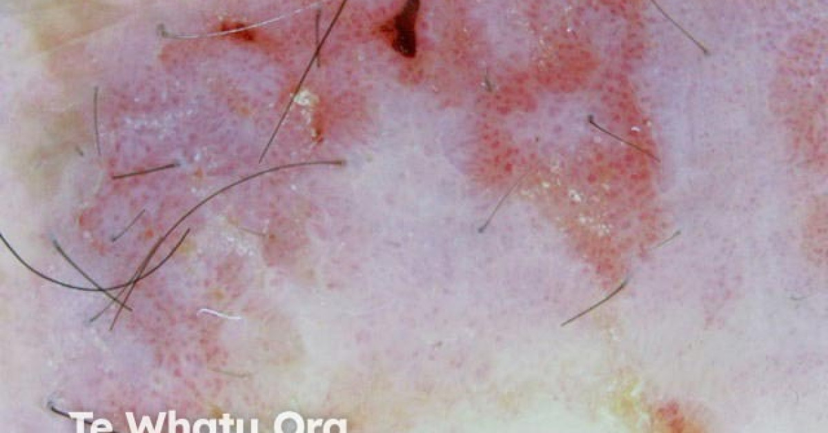 Intraepidermal carcinoma dermoscopy image