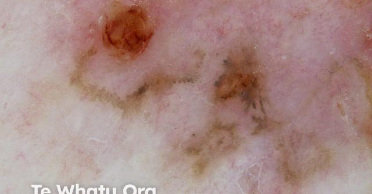 Intraepidermal carcinoma dermoscopy image