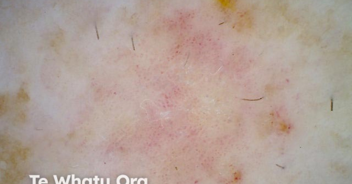 Intraepidermal carcinoma dermoscopy image