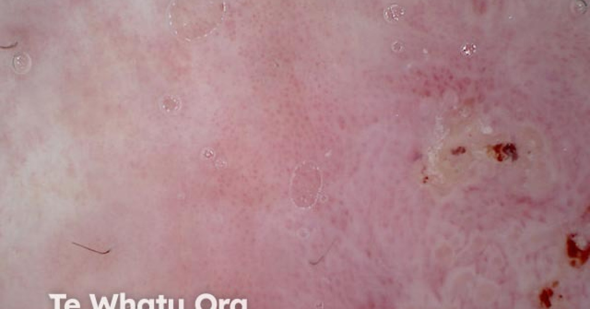 Intraepidermal carcinoma dermoscopy image