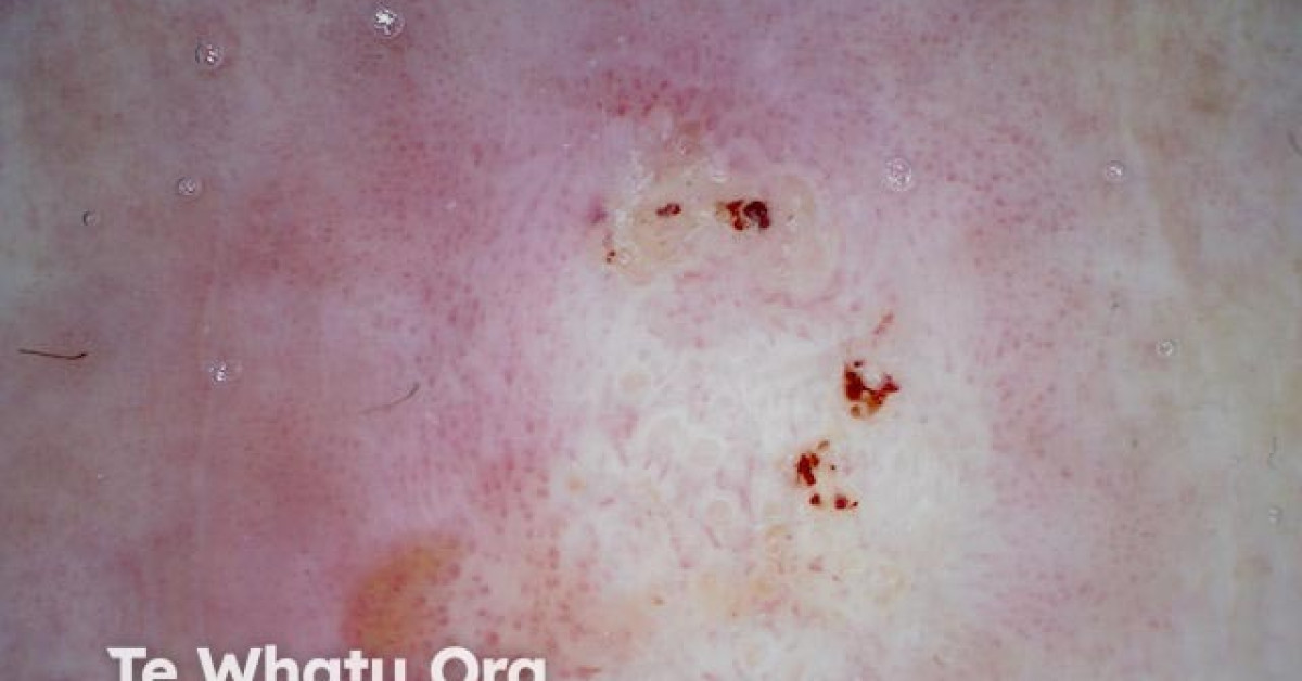 Intraepidermal carcinoma dermoscopy image