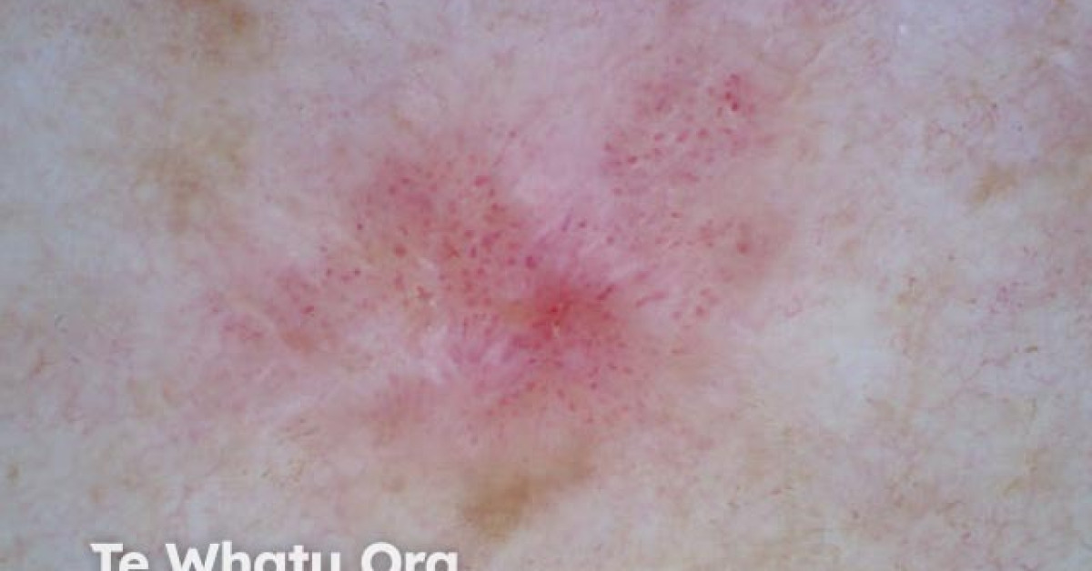 Intraepidermal carcinoma dermoscopy image