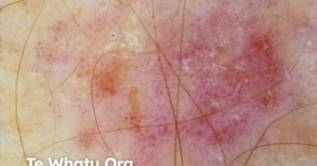 Intraepidermal carcinoma dermoscopy image