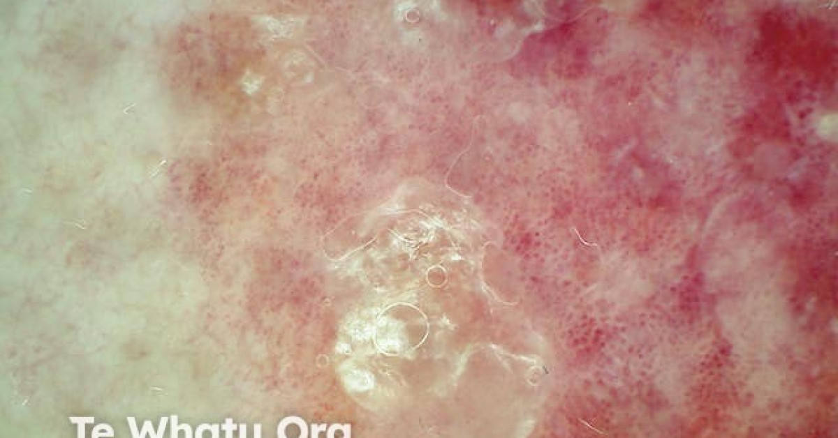 Intraepidermal carcinoma dermoscopy image