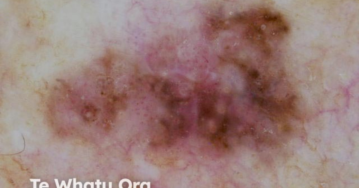 Intraepidermal carcinoma dermoscopy image