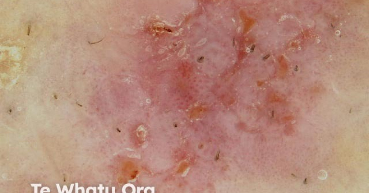 Intraepidermal carcinoma dermoscopy image