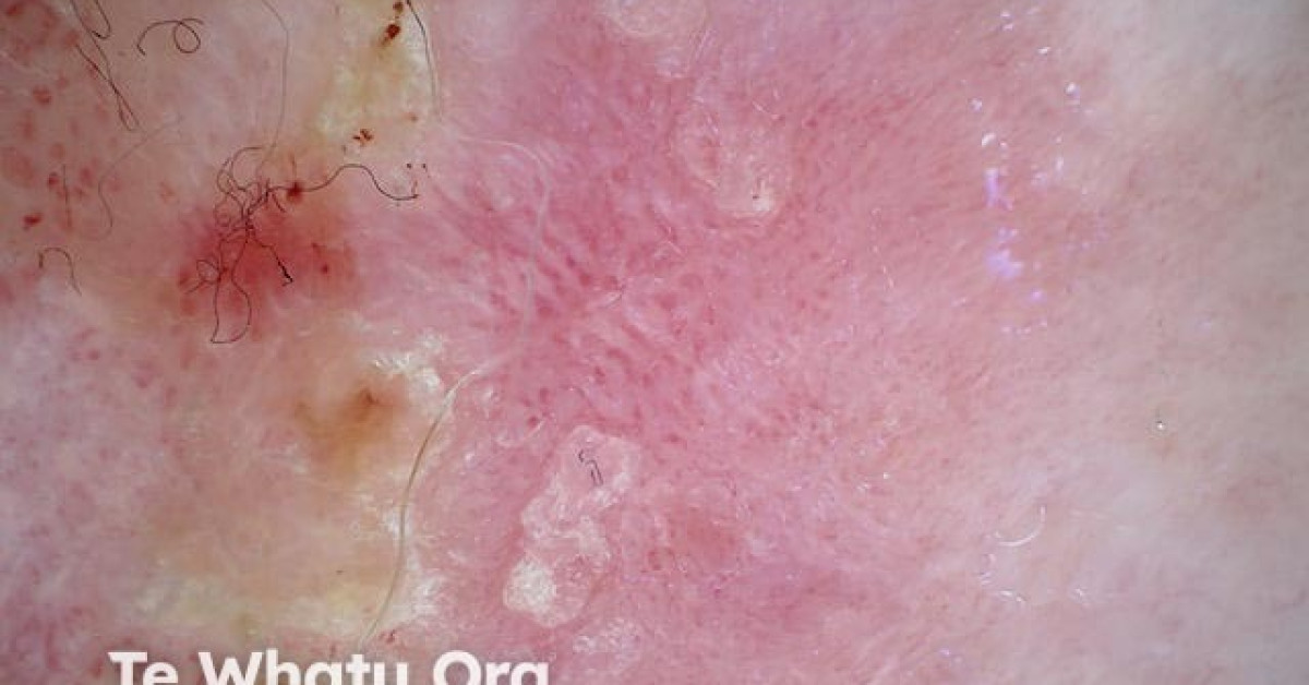 Intraepidermal carcinoma dermoscopy image