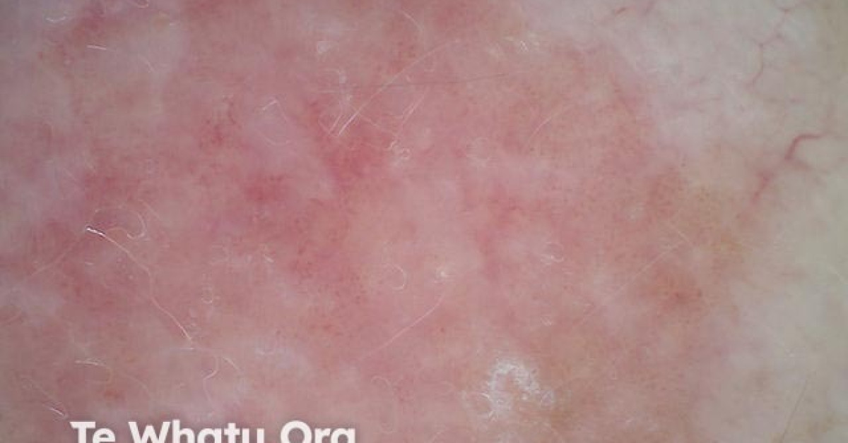 Intraepidermal carcinoma dermoscopy image