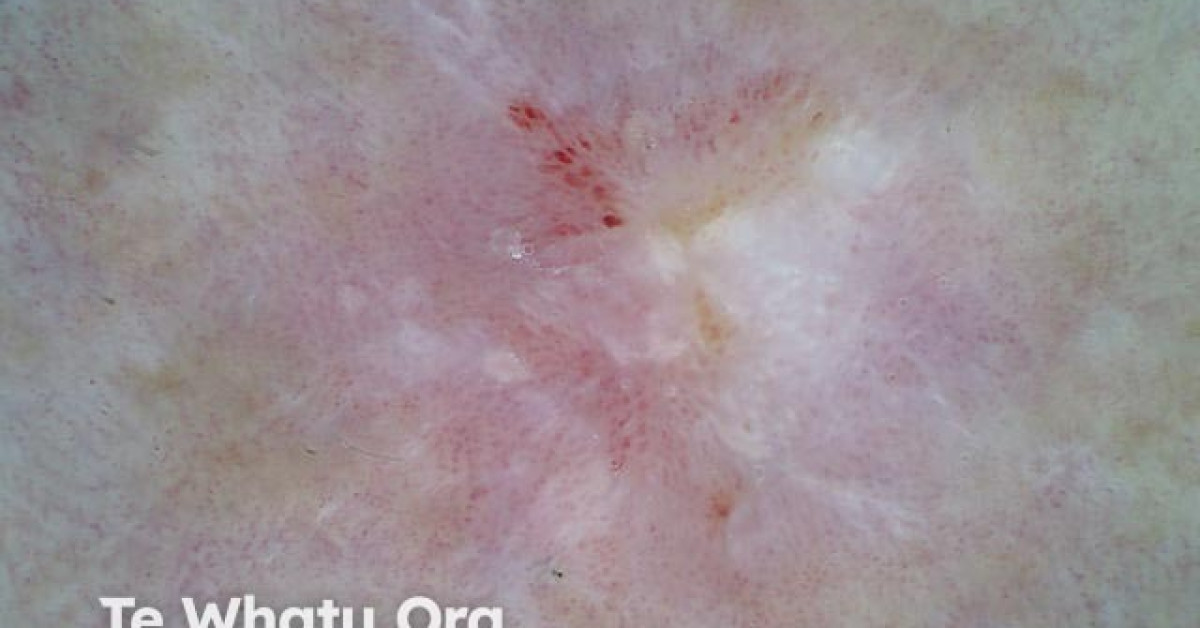 Intraepidermal carcinoma dermoscopy image