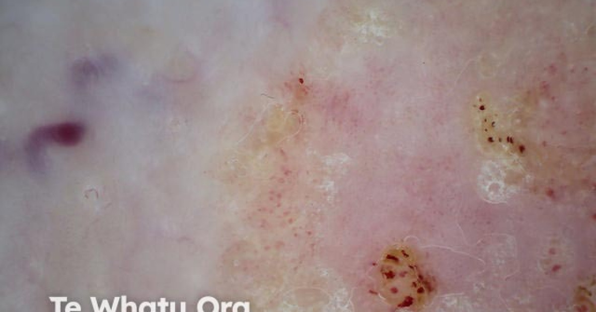 Intraepidermal carcinoma dermoscopy image