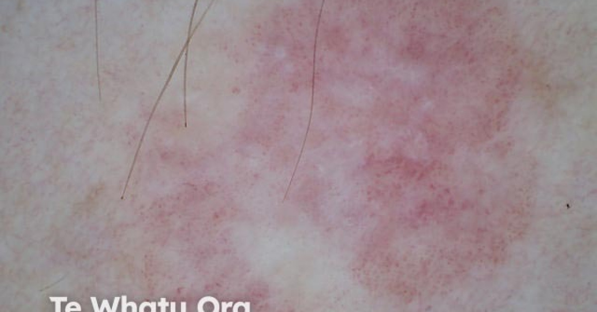 Intraepidermal carcinoma dermoscopy image