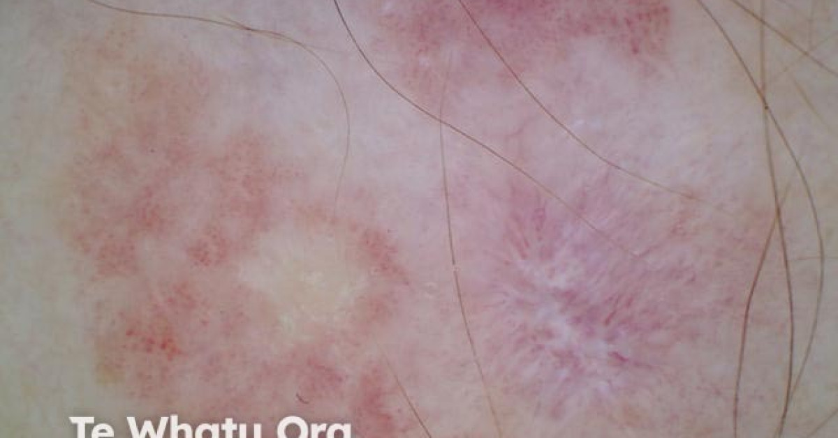 Intraepidermal carcinoma dermoscopy image