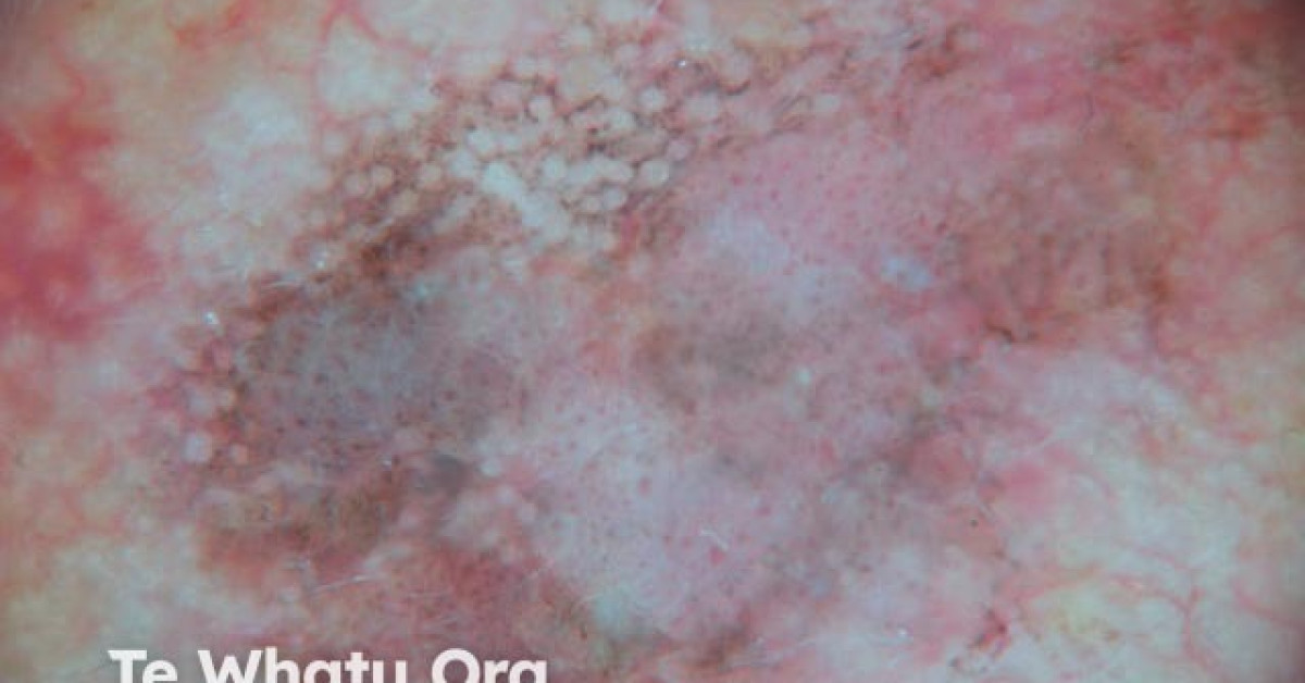 Grey circles in pigmented intraepidermal carcinoma image