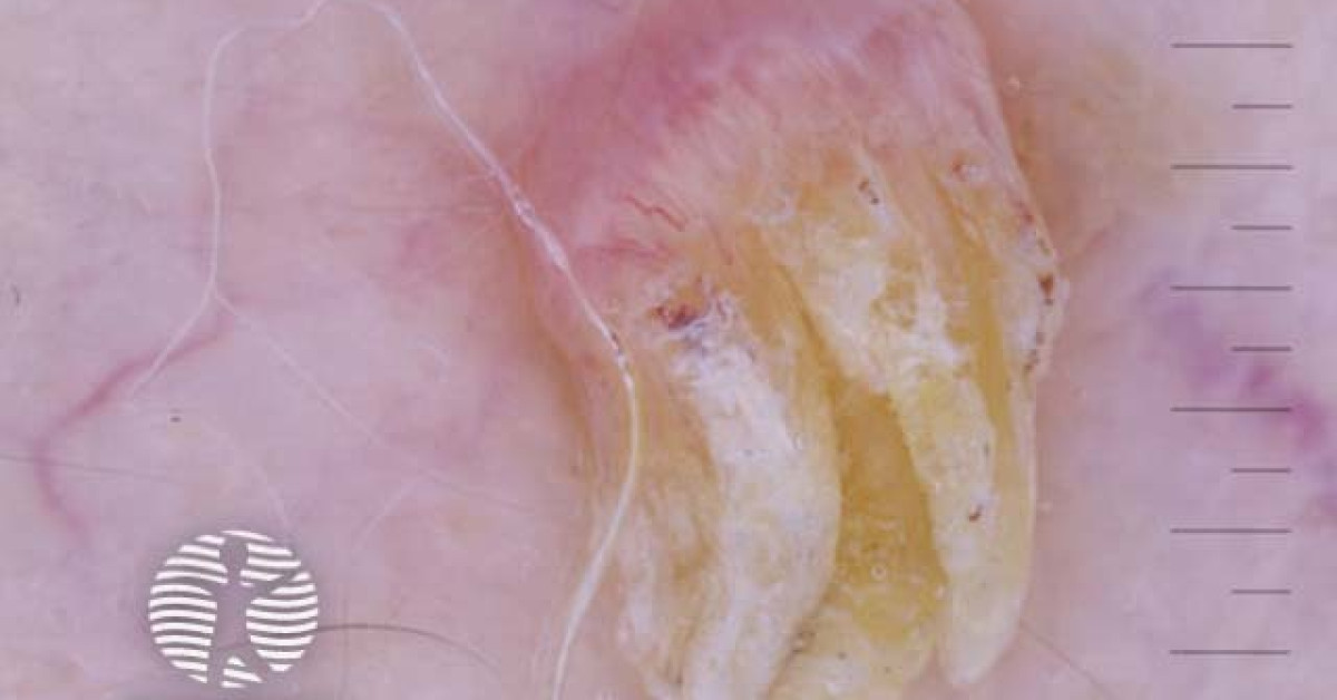 Keratoacanthoma dermoscopy image