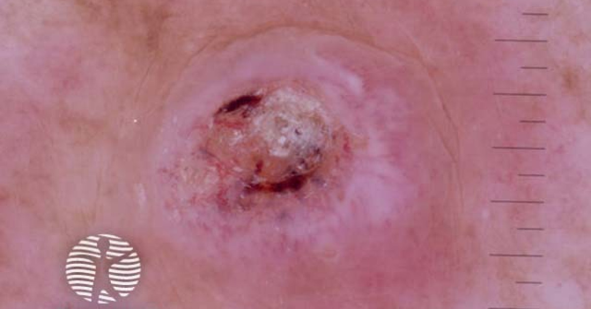 Keratoacanthoma nonpolarised dermoscopy view image