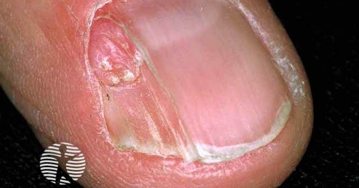 Koenen tumor in tuberous sclerosis image