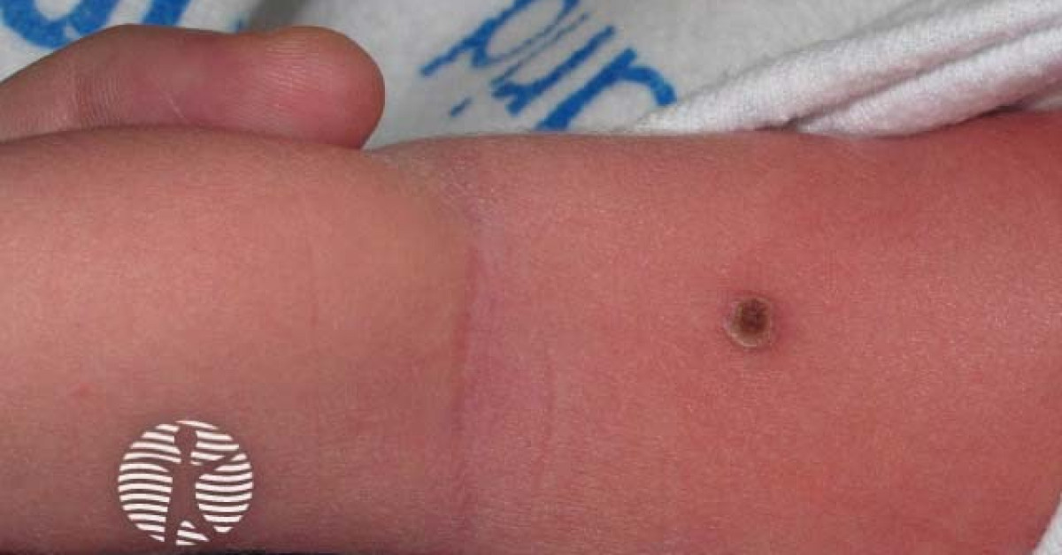 Langerhans cell histiocytosis image