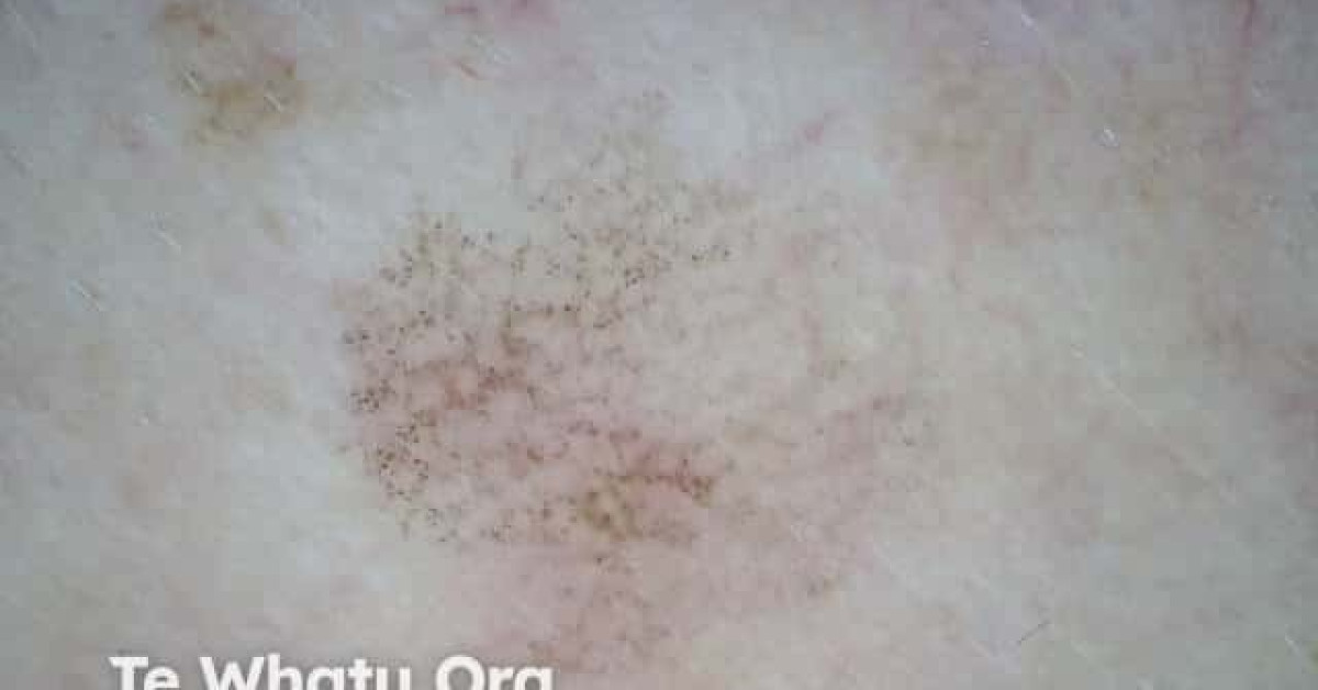 Annular granular pattern seen in dermoscopy of lichen planus-like ...