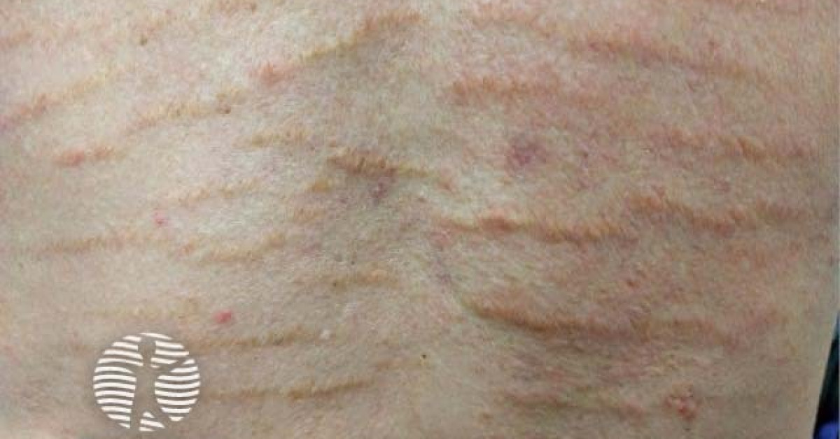 Elastosis Dermnet New Zealand