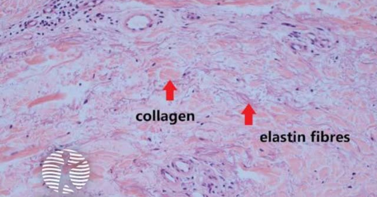 Histology of linear focal elastosis image