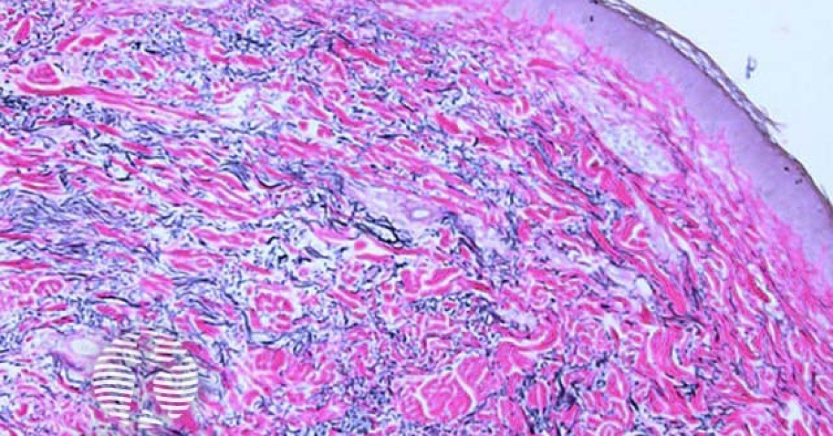 Histology of linear focal elastosis image