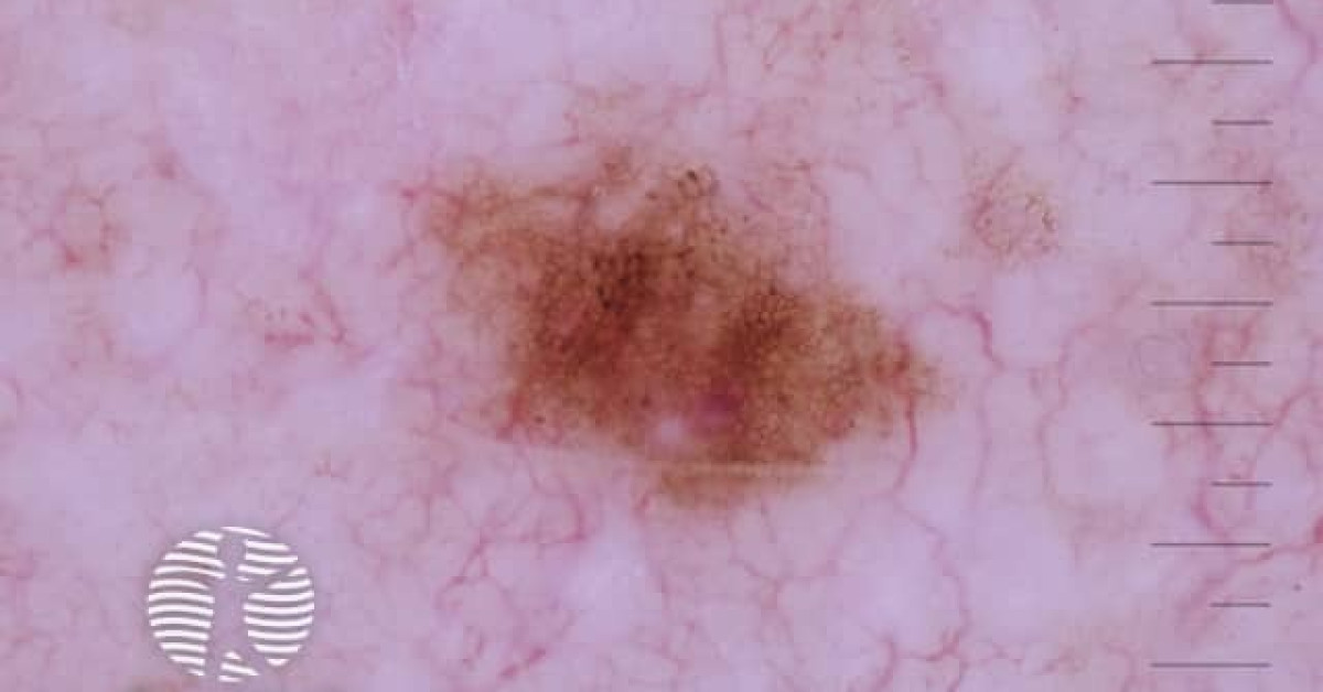 Melanoma in situ dermoscopy image