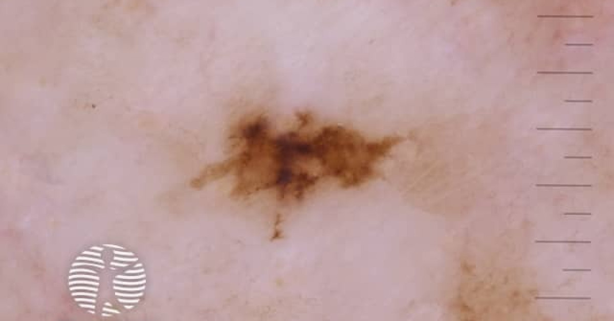 Angulated lines in dermoscopy of melanoma image