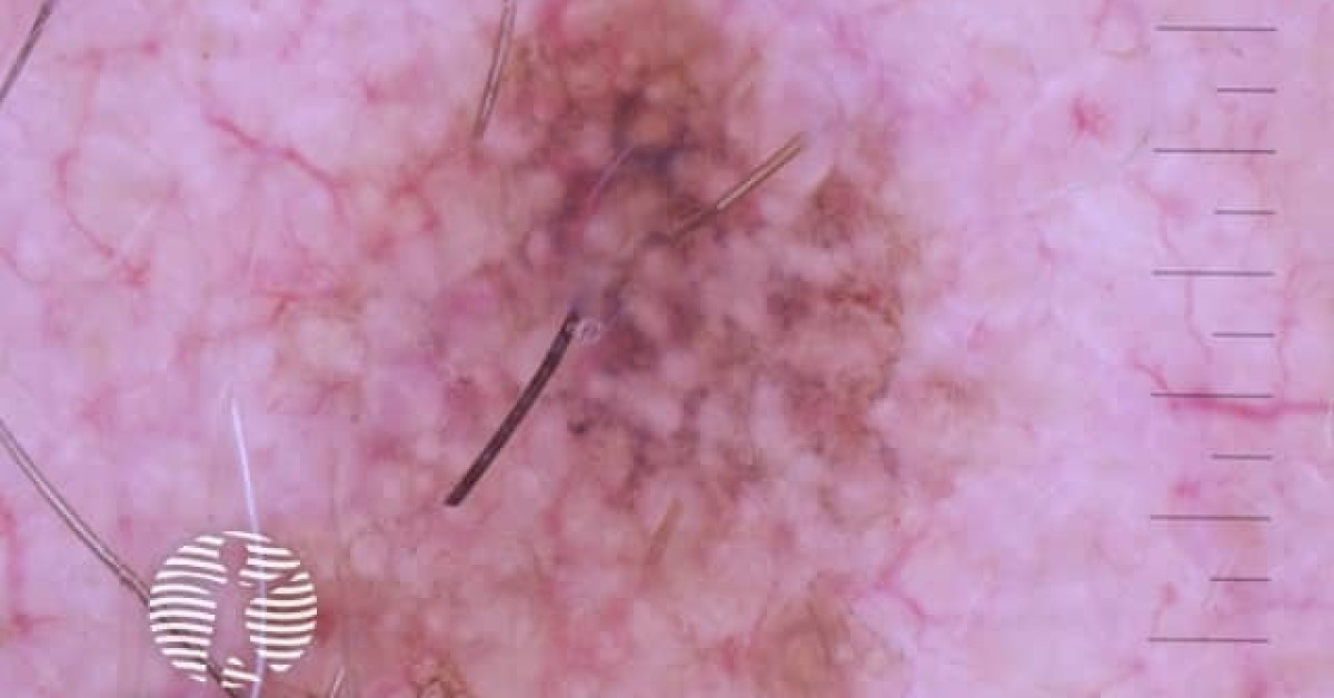 Melanoma in situ dermoscopy image