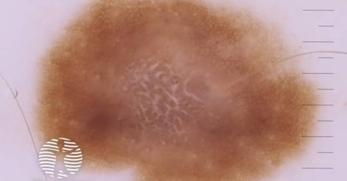 Melanoma in situ dermoscopy image