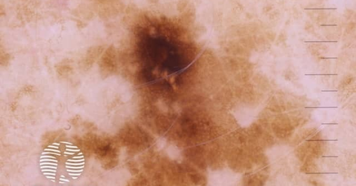 Melanoma in situ dermoscopy image