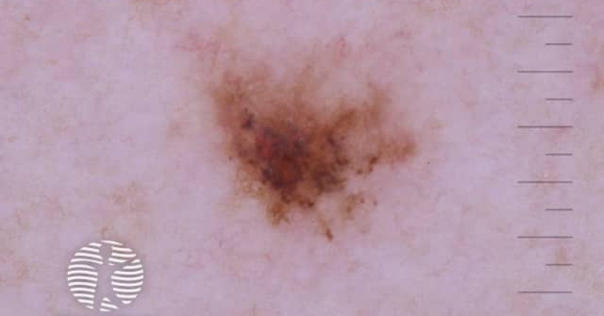 Angulated Lines image