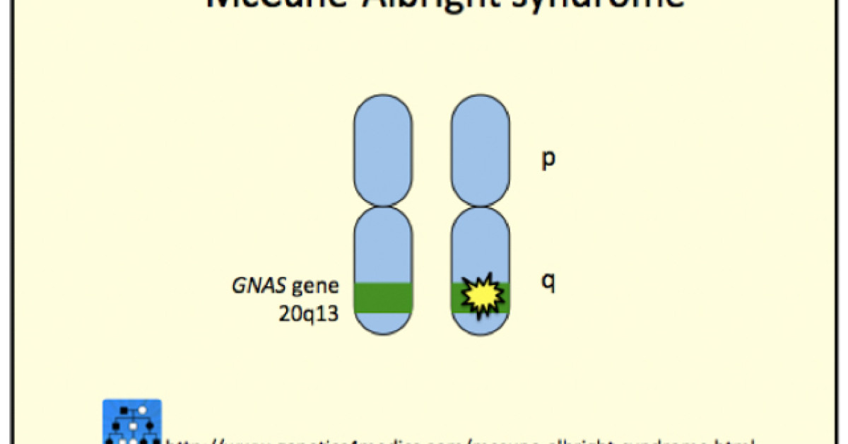 McCune Albright Syndrome image