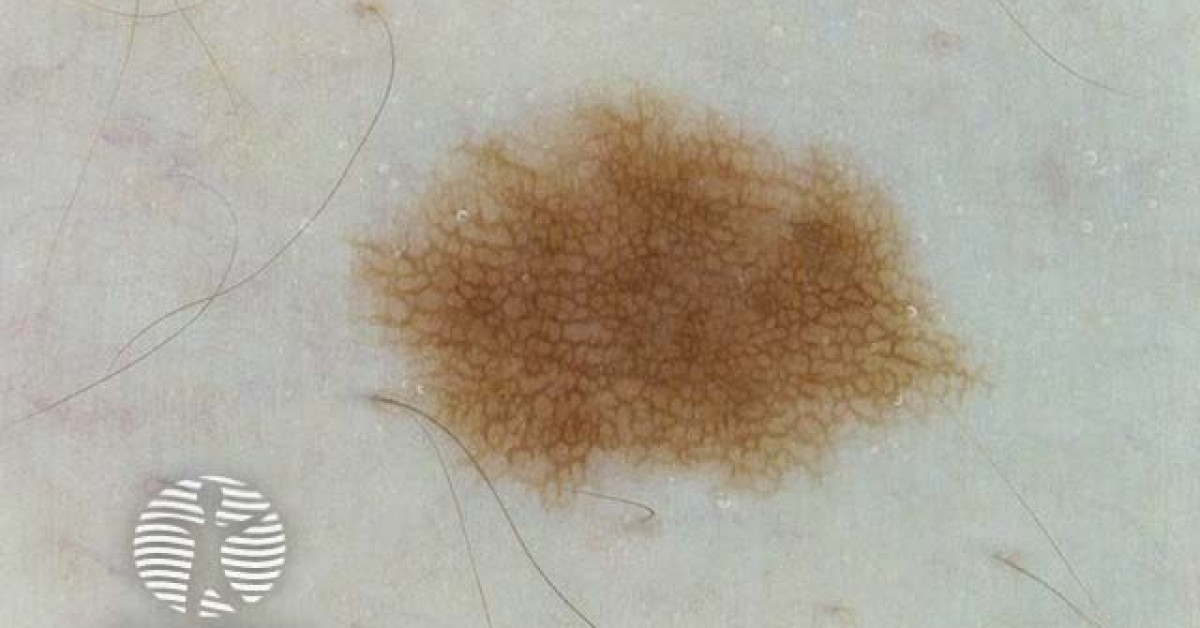 Naevus, skin type 3, dermoscopy image