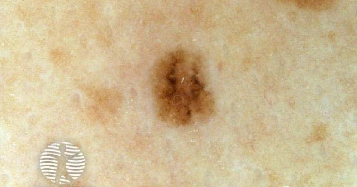Naevus, skin type 3, macro image