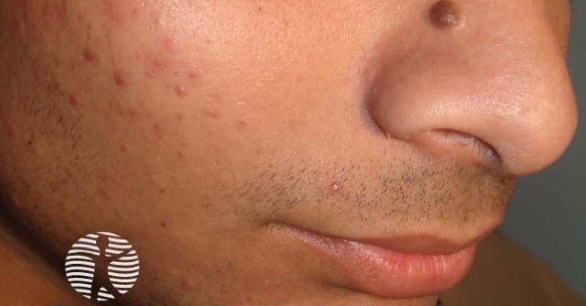 Melanocytic naevus, skin type 5 image