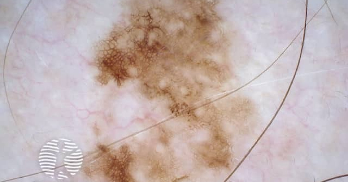 Melanoma in situ 11 dermoscopy image