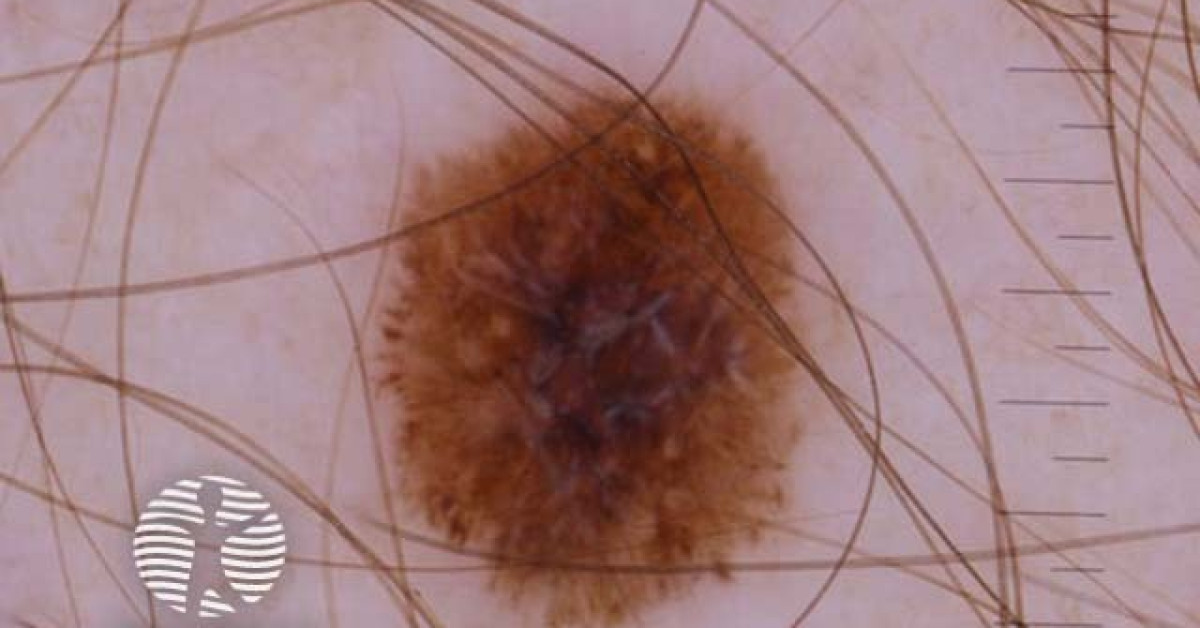 Perpendicular white lines are visible under polarised light dermoscopy ...