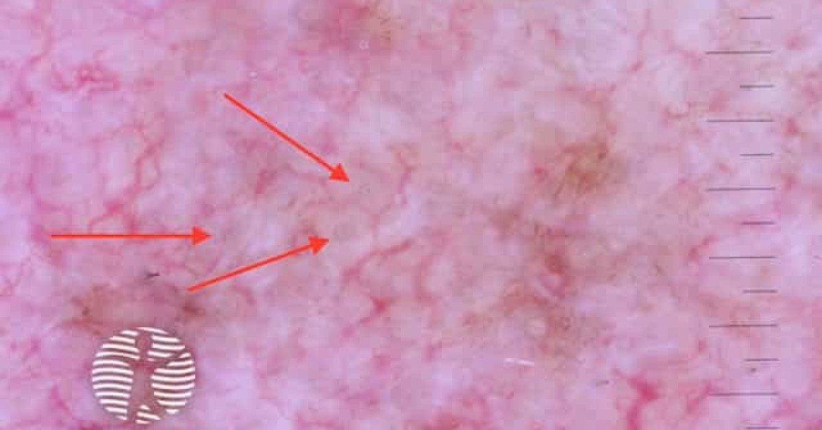 Concentric circles (red arrows) seen in dermoscopy of lentigo maligna image