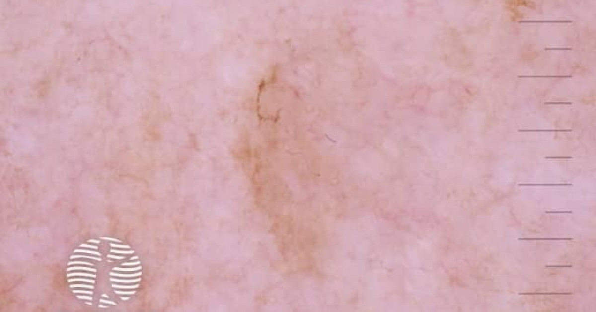 Angulated lines in dermoscopy of melanoma image