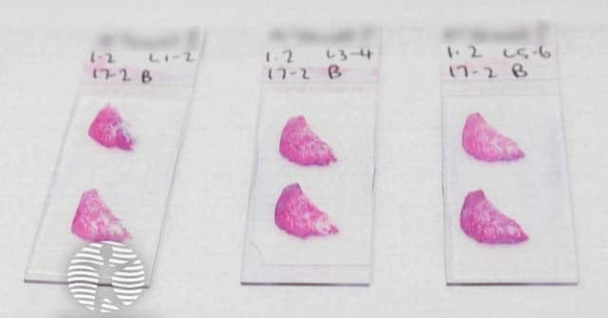 DermNet® - Mohs sections image