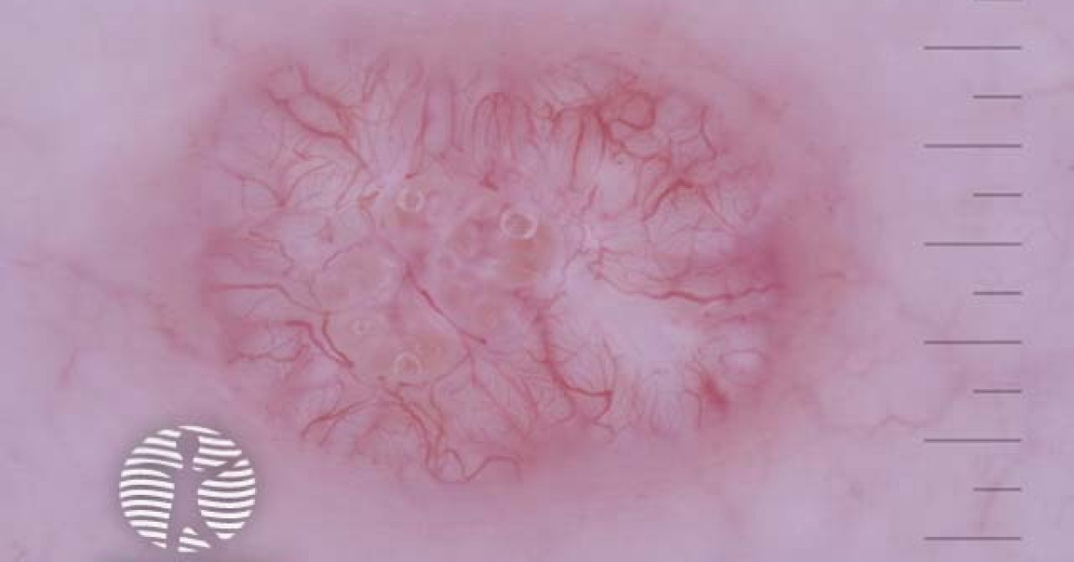 Molluscum contagiosum image
