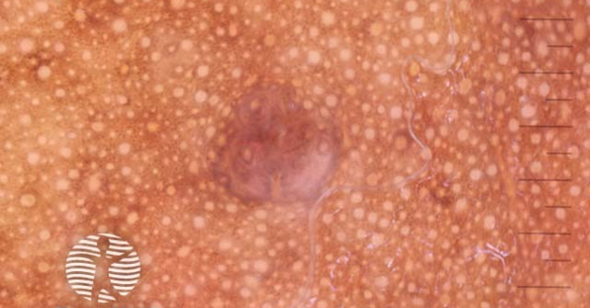 Naevus, skin type 6, dermoscopy image