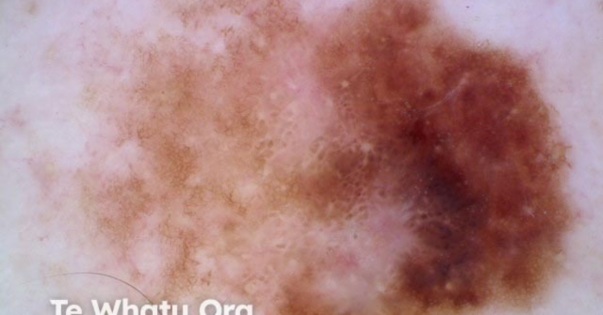 Melanoma in situ in collision with a benign dermal naevus image