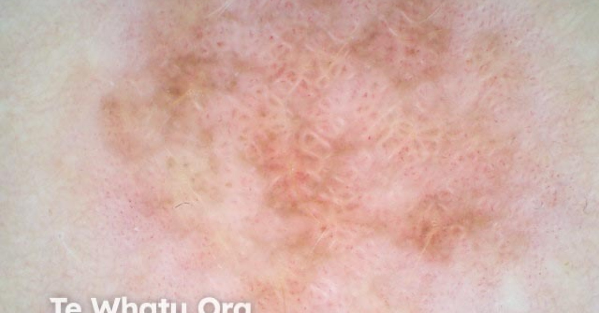 Congenital naevus image