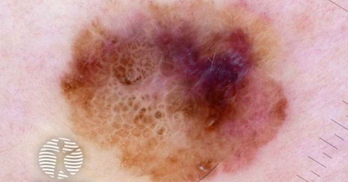 Superficial spreading melanoma in situ arising from an atypical naevus ...